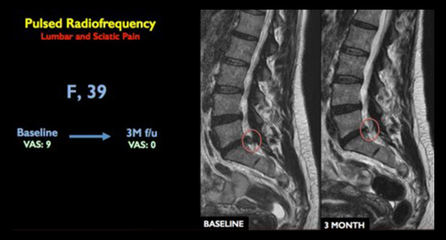 Pulsed Radiofrequency Relieves Low Back Pain, Sciatica – PainCast