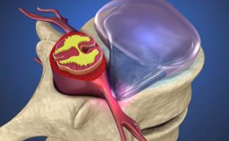 Transformainal Epidural Steroid Injection Superior to Caudal in ...