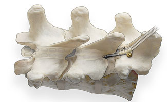 Mitigating Spinal Cord Stimulator Lead Migration Complications in ...