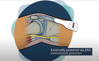 How ‘Injectrode’ Could Change Treatment of Chronic Pain - PainCast
