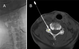 A Novel Approach of Ultrasound-Guided Transforaminal Cervical Nerve ...