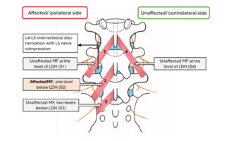Microscopic changes in the multifidus muscle in people with low back pain associated with lumbar ...